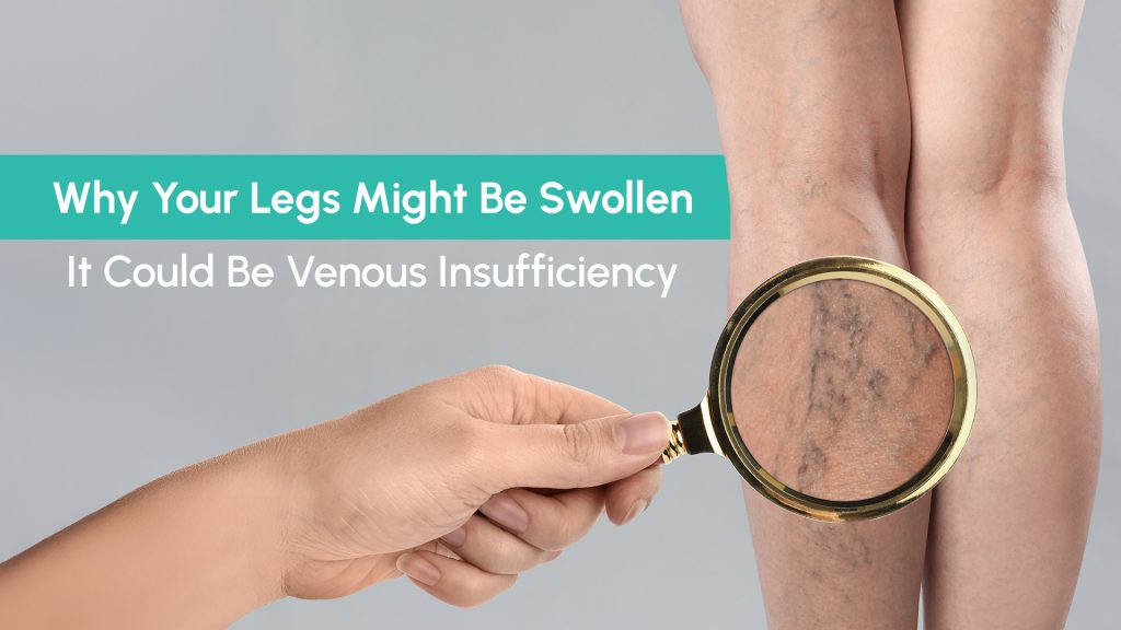 Venous Insufficiency Explained: Why Your Legs Are Swollen