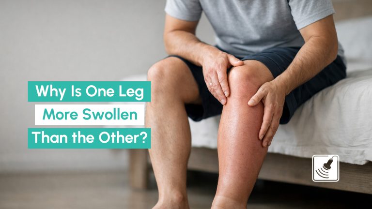 One Leg Swelling: Causes and When to Get It Checked
